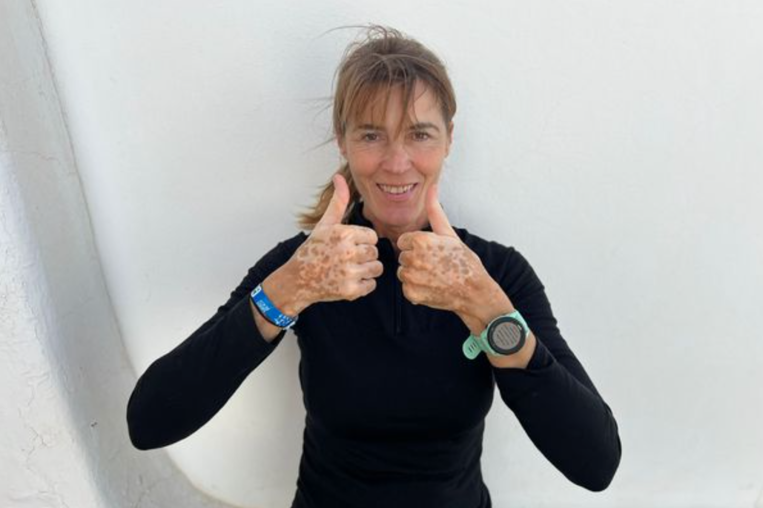 L’animatrice Nathalie Simon affiche son vitiligo et soutient les ...