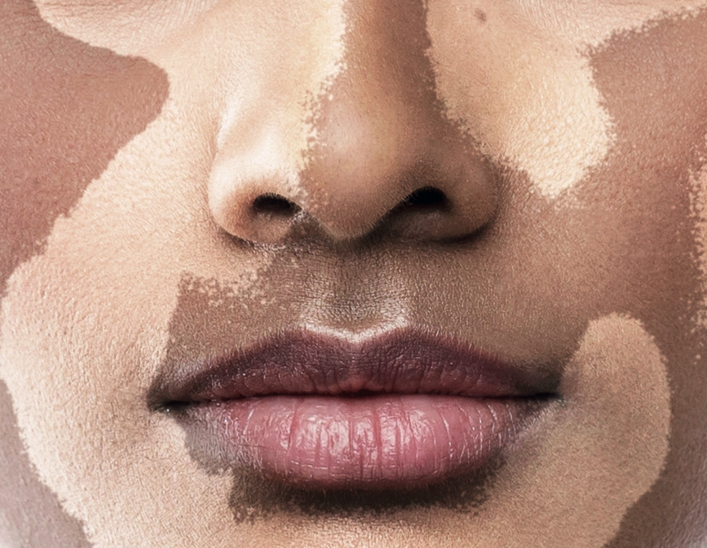 Etude : un cosmétique pour maintenir la pigmentation des lésions ...